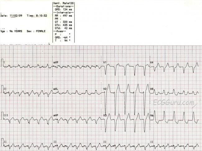 Atrial Flutter With 21 Conduction And Left Bundle Branch Block Ecg